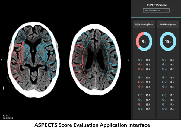 Xây dựng hệ thống hỗ trợ chấm điểm ASPECTS Score từ ảnh CT não bệnh ...
