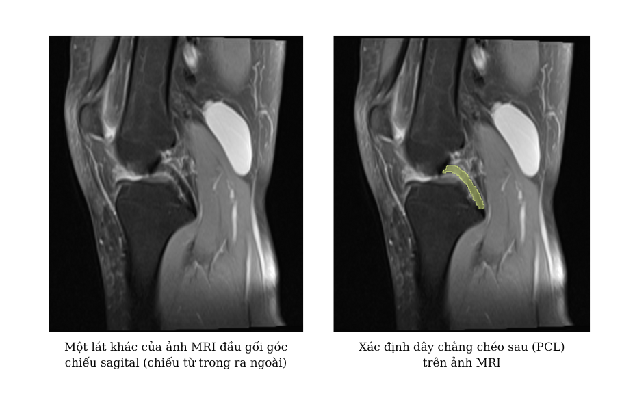 Xây dựng hệ thống hỗ trợ chẩn đoán tổn thương dây chằng chéo từ ảnh MRI ...