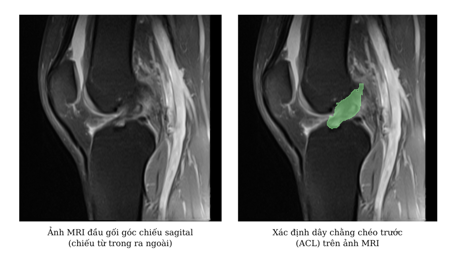 Xây dựng hệ thống hỗ trợ chẩn đoán tổn thương dây chằng chéo từ ảnh MRI ...
